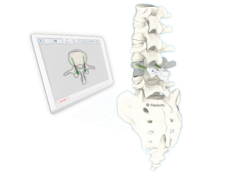 Salari Performs Spine Surgery with "MySpine MC” | DISC