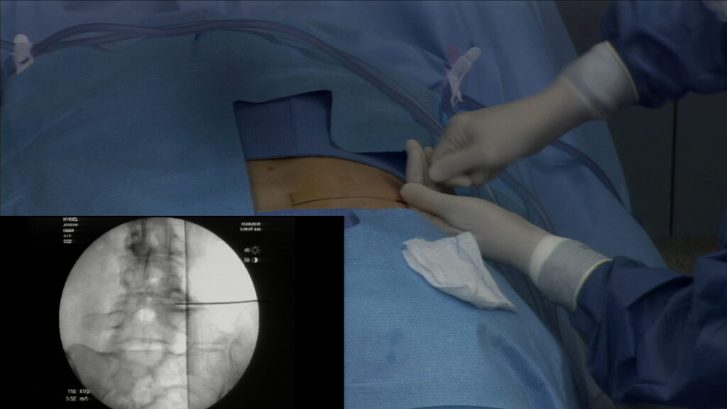 Foraminal Osteophytes & Decompression | DISC of Arizona