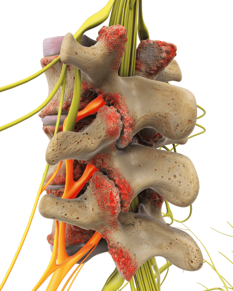 Diagnosis and Treatment of Spinal Bone Spurs in AZ | DISC