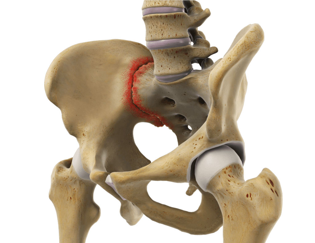 SI Joint Dysfunction: Causes, Symptoms and Treatment | DISC
