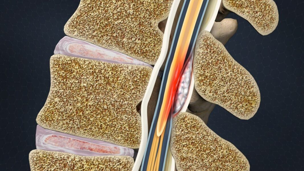 Spinal Myelopathy - Desert Institute for Spine Care