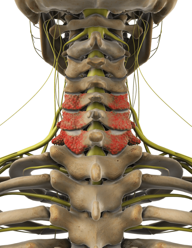 Diagnosis and Treatment for Foraminal Stenosis in AZ | DISC
