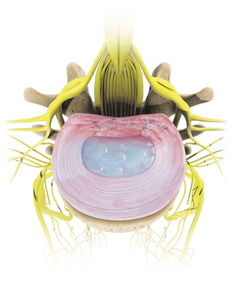 Degenerative Disc Disease: Causes and Symptoms | DISC