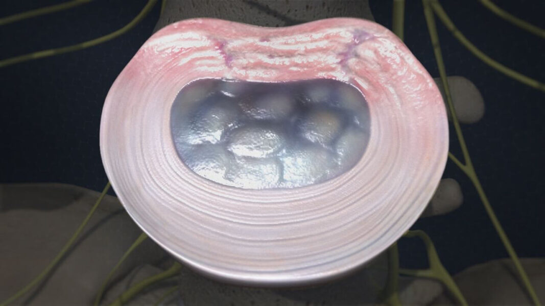Annular Disc Tear Diagnosis and Treatment in Arizona | DISC
