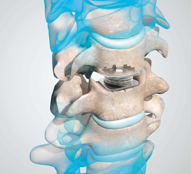 Artificial Disc Replacement Questions and Answers | DISC
