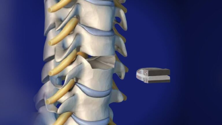 Next-Generation M6-C™ Artificial Cervical Disc | DISC