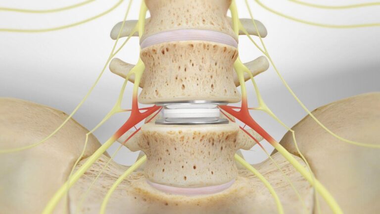 Lumbar Artificial Disc Replacement | Spine Treatments