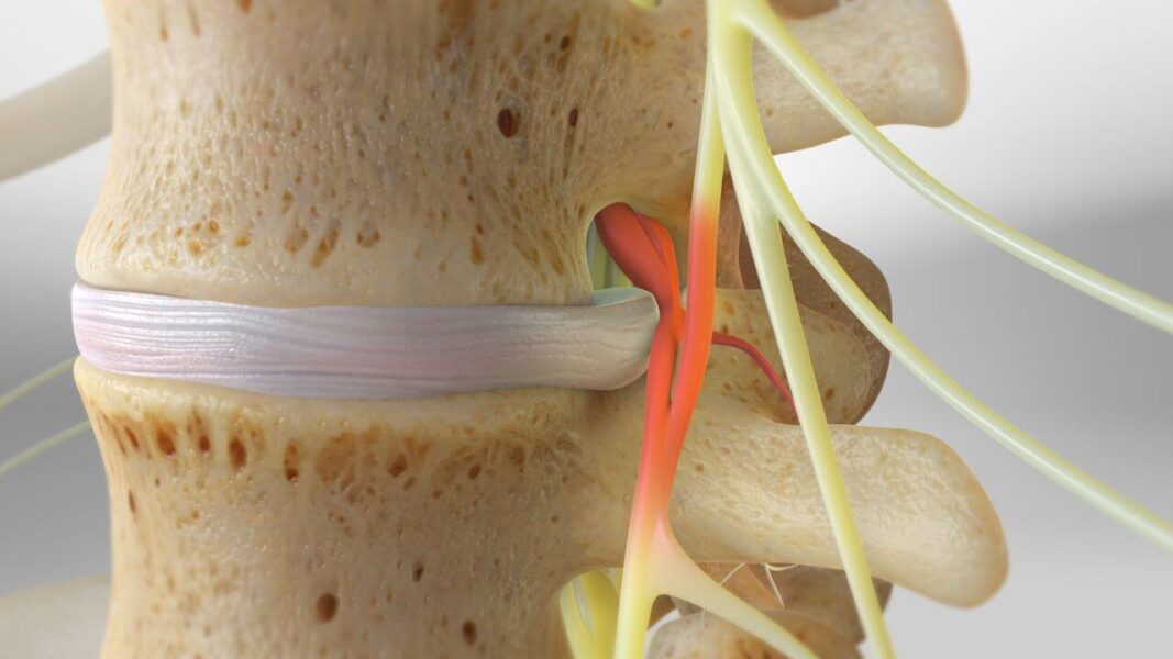 Cervical Artificial Disc Replacement | DISC Treatments