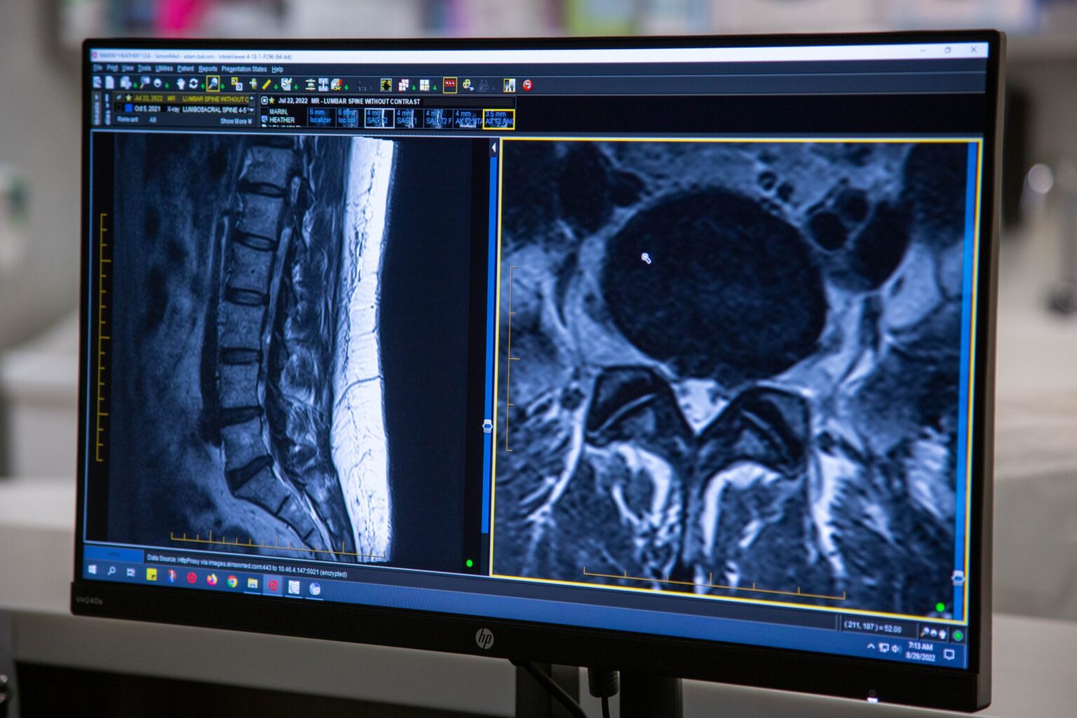 Ultra Minimally Invasive Spine Surgery | DISC Treatments
