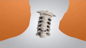 Next-Generation M6-C™ Artificial Cervical Disc | DISC