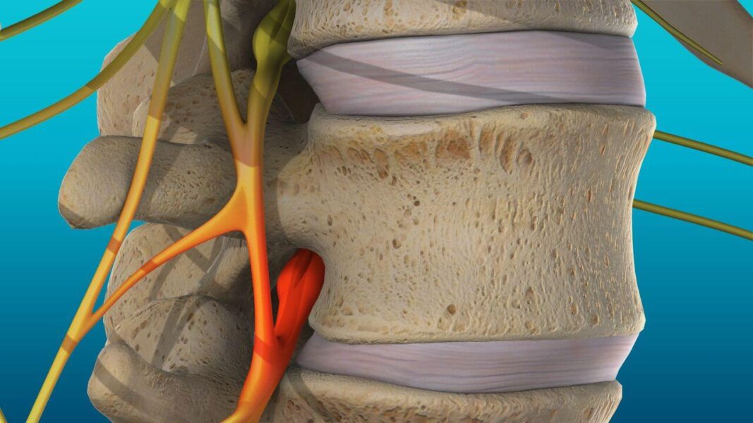 Radiculitis Diagnosis and Treatment in Arizona | DISC