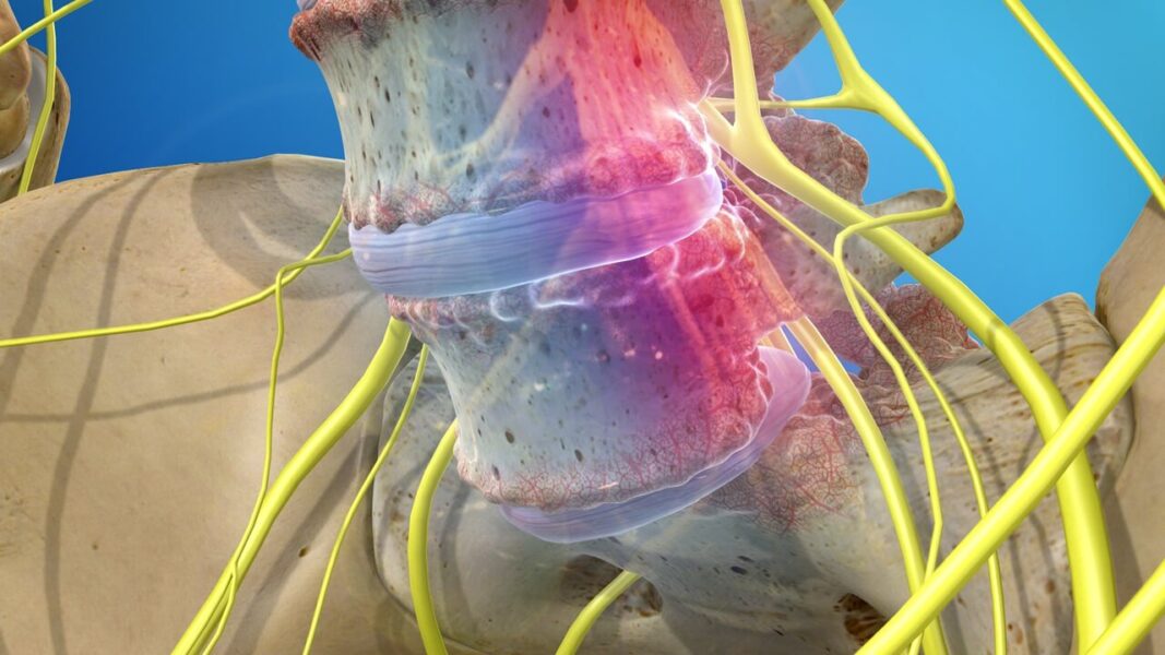 Extreme Lateral Interbody Fusion (XLIF) - Desert Institute for Spine Care