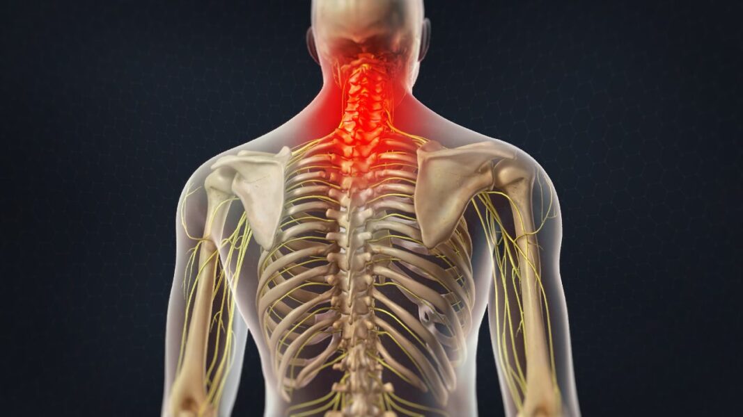 Anterior Cervical Decompression and Fusion Surgery | DISC