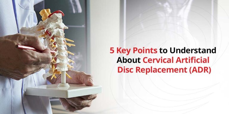Five Key Points About Cervical Artificial Disc Replacement