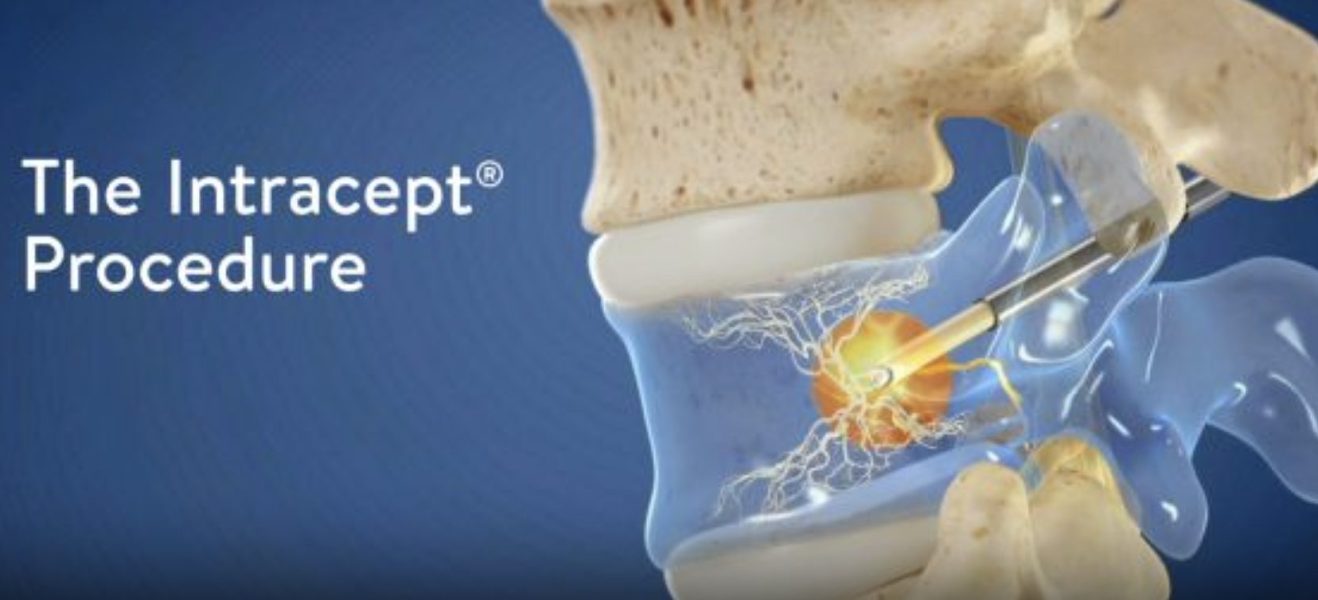 Intracept® Procedure for Chronic Lower Back Pain | DISC
