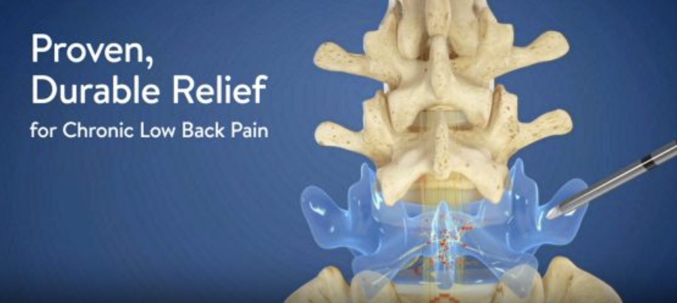 Intracept® Procedure for Chronic Lower Back Pain | DISC