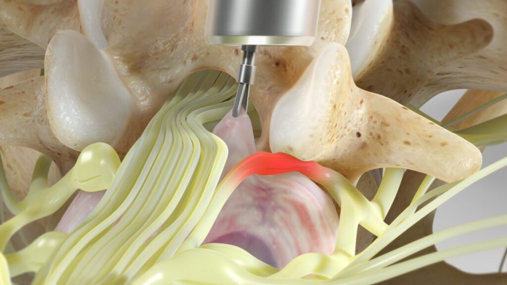 9 Sciatica Treatment Options for Severe Spinal Pain | DISC