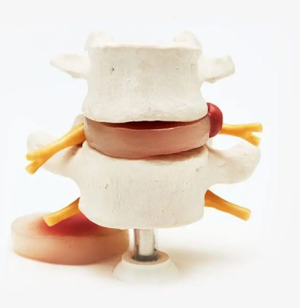 Lumbar Artificial Disc Replacement | Spine Treatments