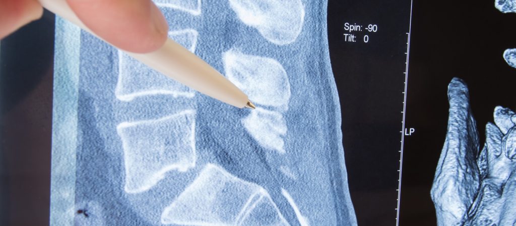 Lumbar Artificial Disc Replacement | Spine Treatments