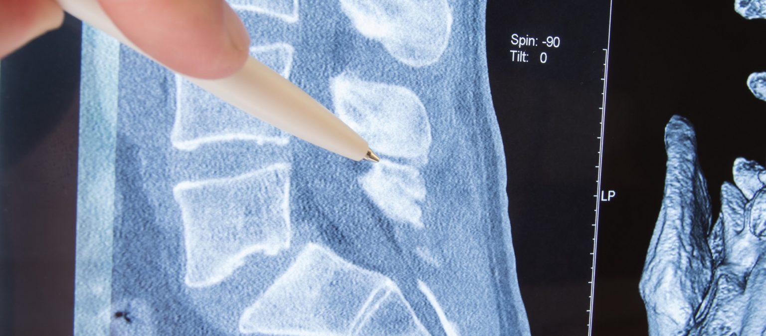 Lumbar Artificial Disc Replacement | Spine Treatments