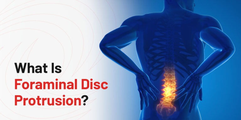 What Is Foraminal Disc Protrusion?
