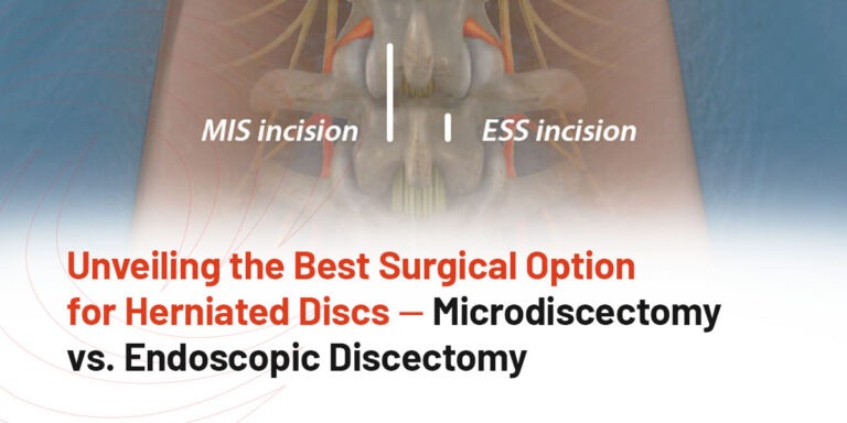 The Bets Surgery for Herniated Discs - Micro vs Endo