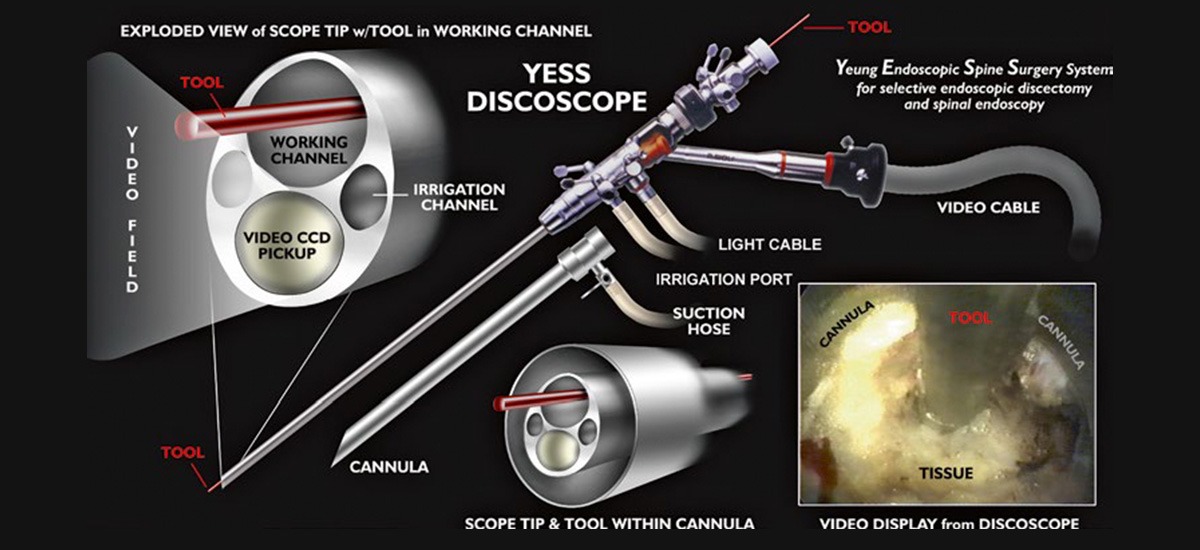 The Role of Lasers in Minimally Invasive Spine Surgery