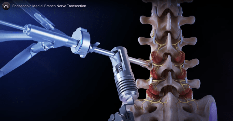 Endoscopic Rhizotomy Surgery and Procedure in Arizona | DISC