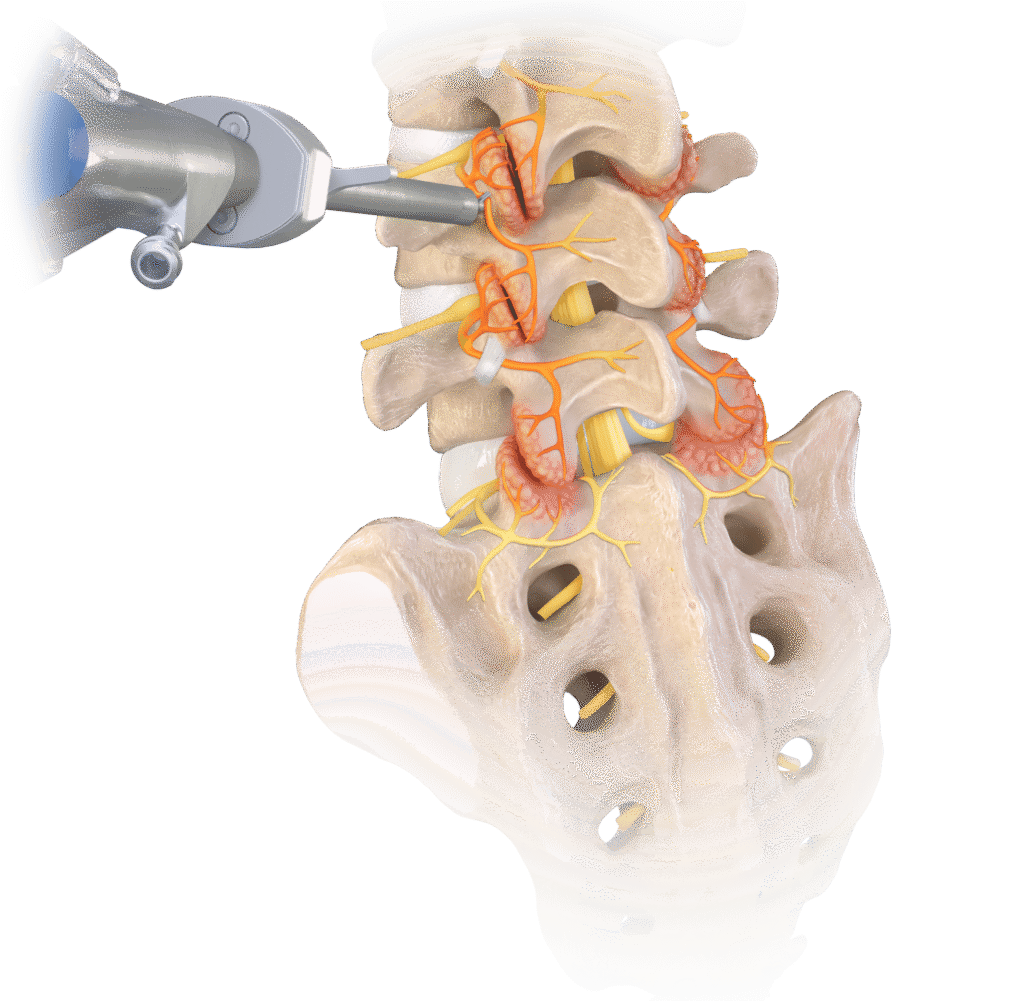 Endoscopic Spine Surgery: Are You a Good Candidate? - Desert Institute ...